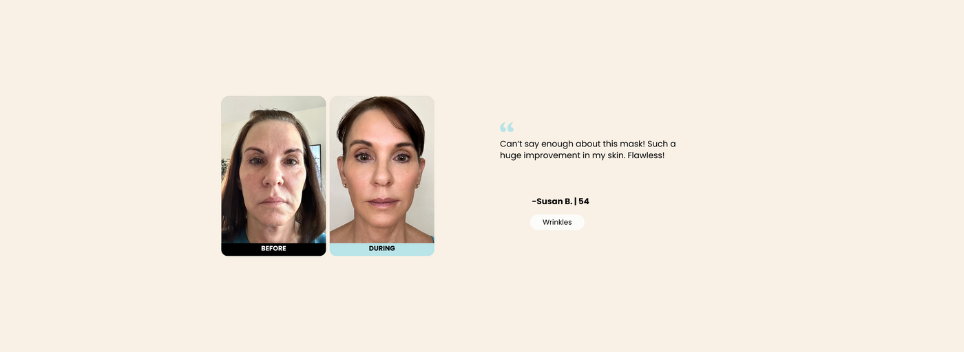 Wrinkle & Acne Clearing Light Therapy Face & Neck Mask – Nutriskin