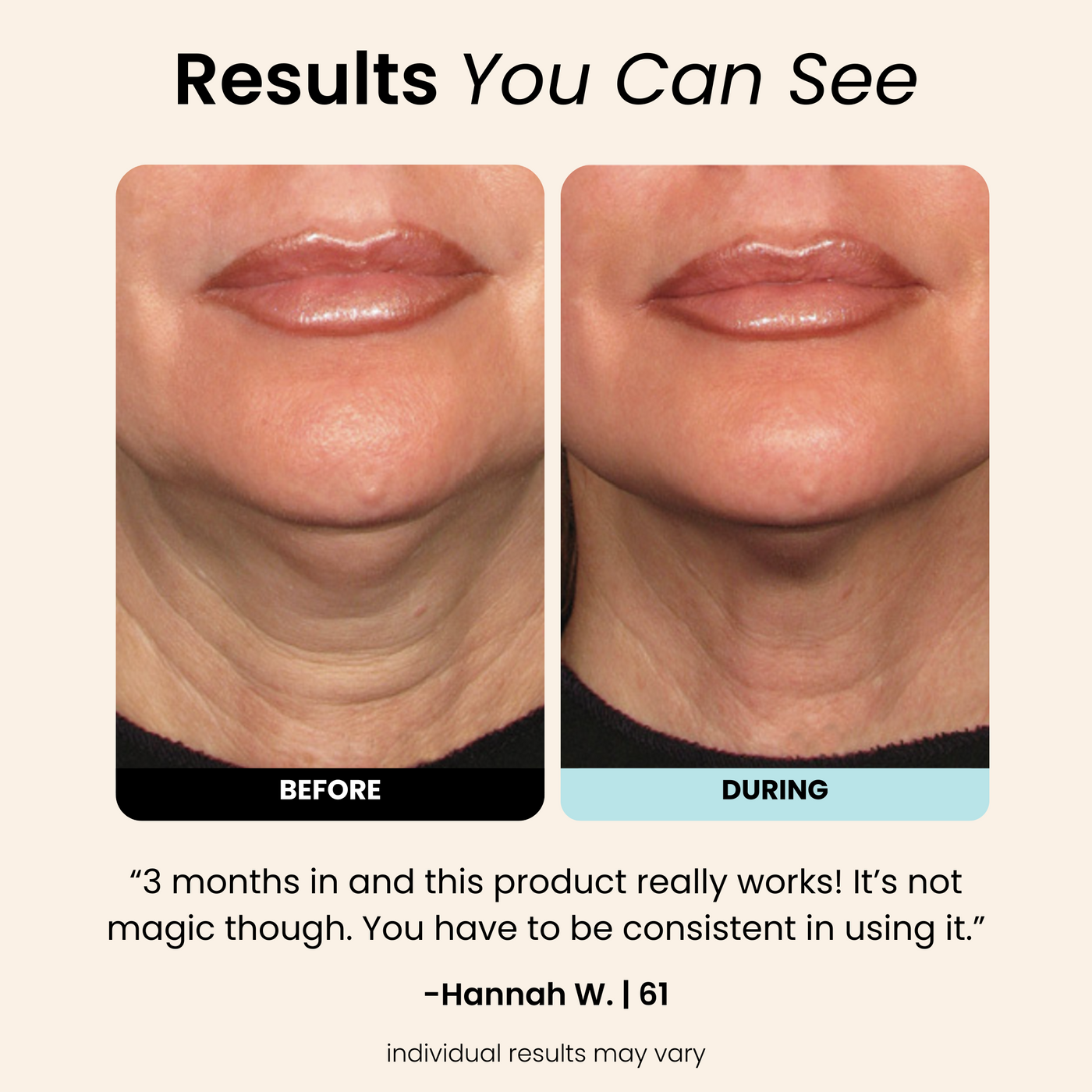 Wrinkle Clearing Light Therapy Face & Neck Mask – Nutriskin